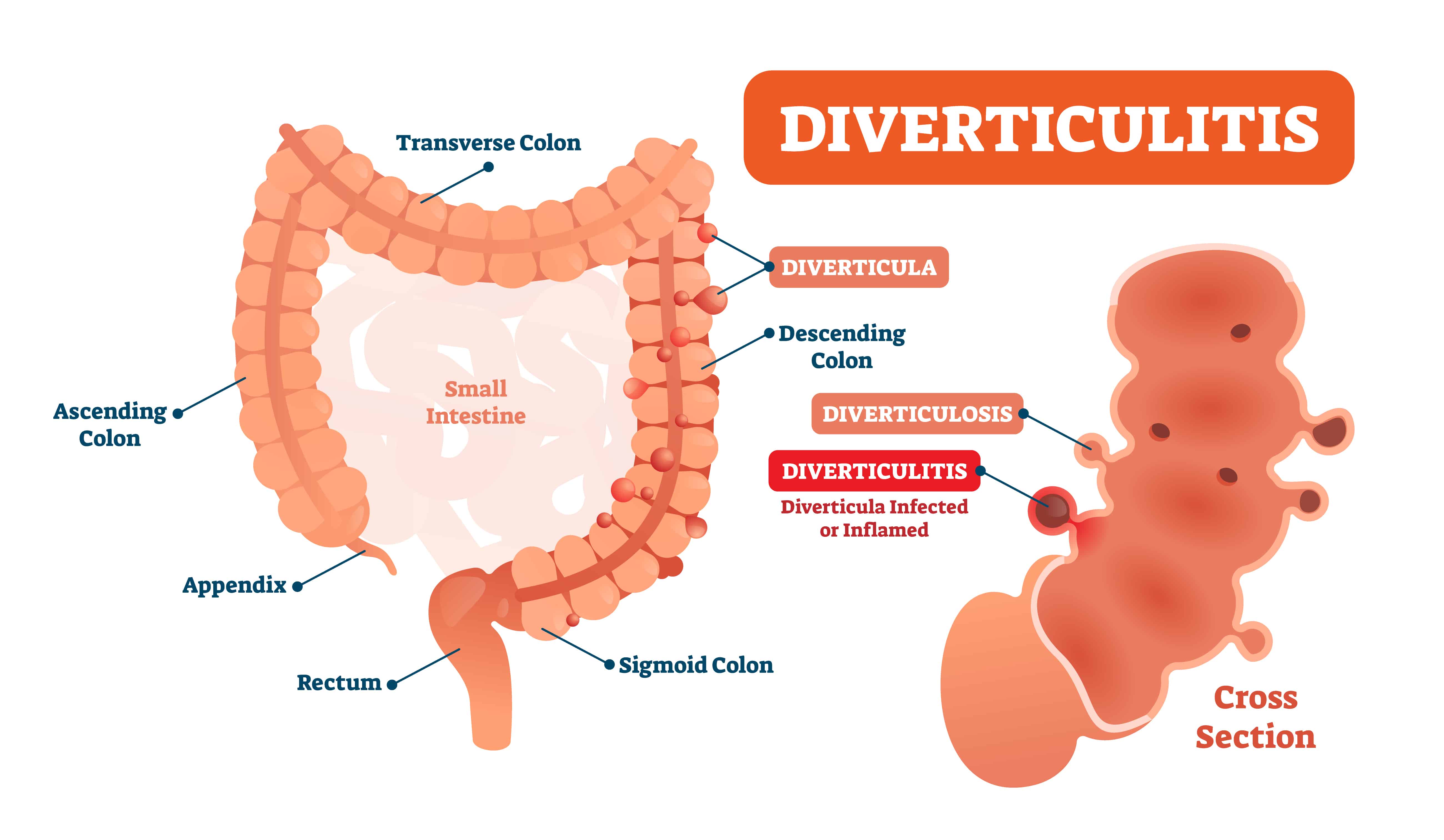 Diverticulitis Dr Angel M Caban Md Laparoscopic Colon Surgery